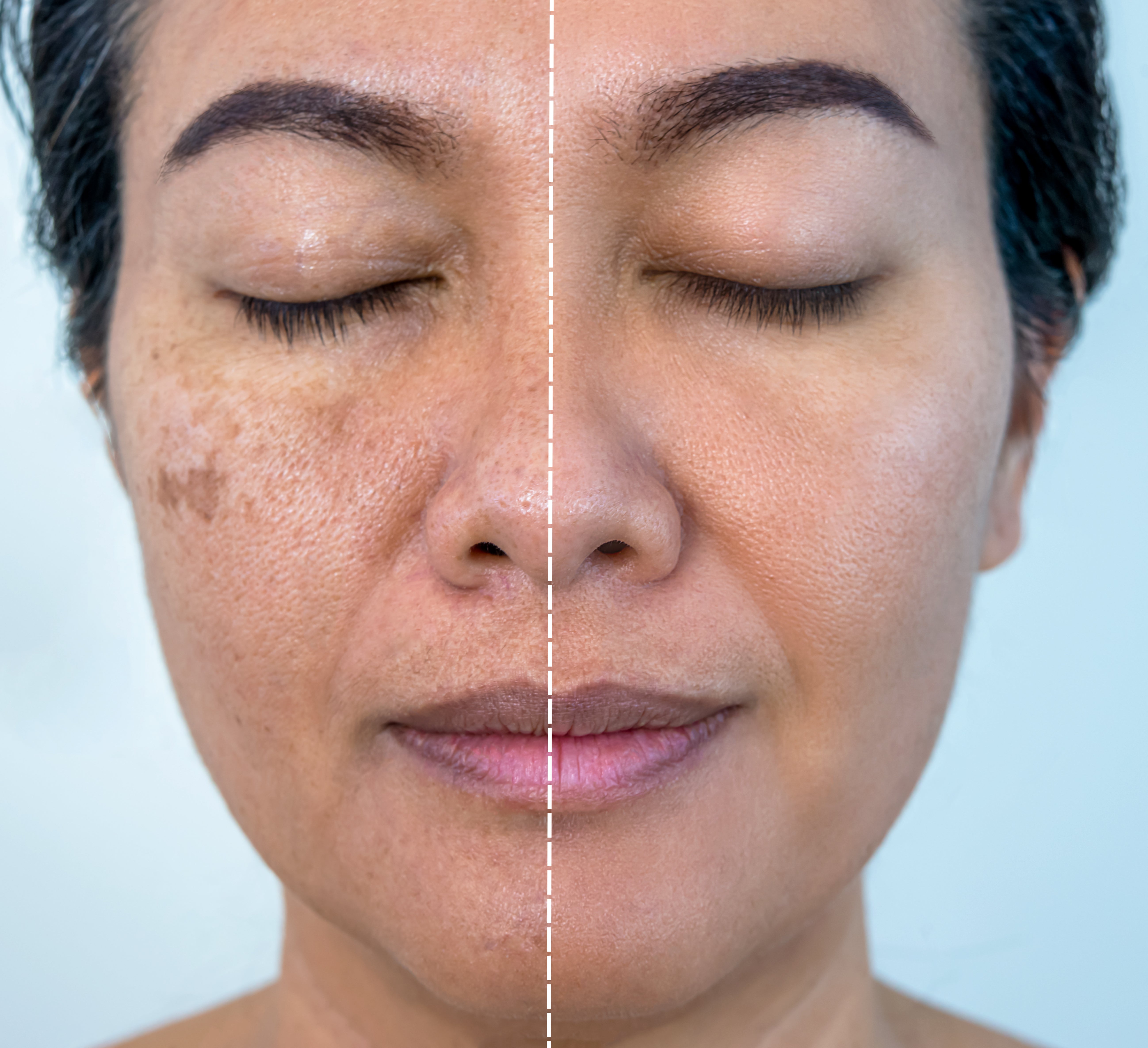 Pigmentation & Uneven Skin Tone Treatment with Hydrodermabrasion ...